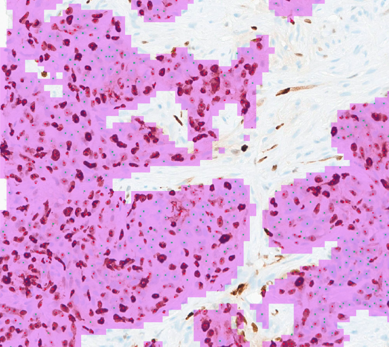 Introducing AIM-IHC Breast Panel